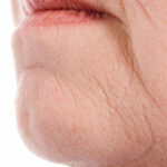 A Quick Guide To Wrinkles Treatments in Singapore