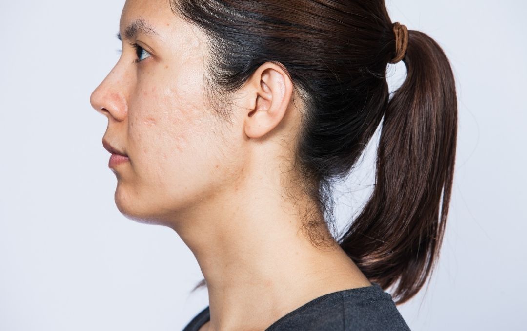 Rejuran S | Become Aesthetics Clinic Singapore