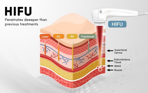 HIFU Facelift Treatment in Singapore | A Complete Guide