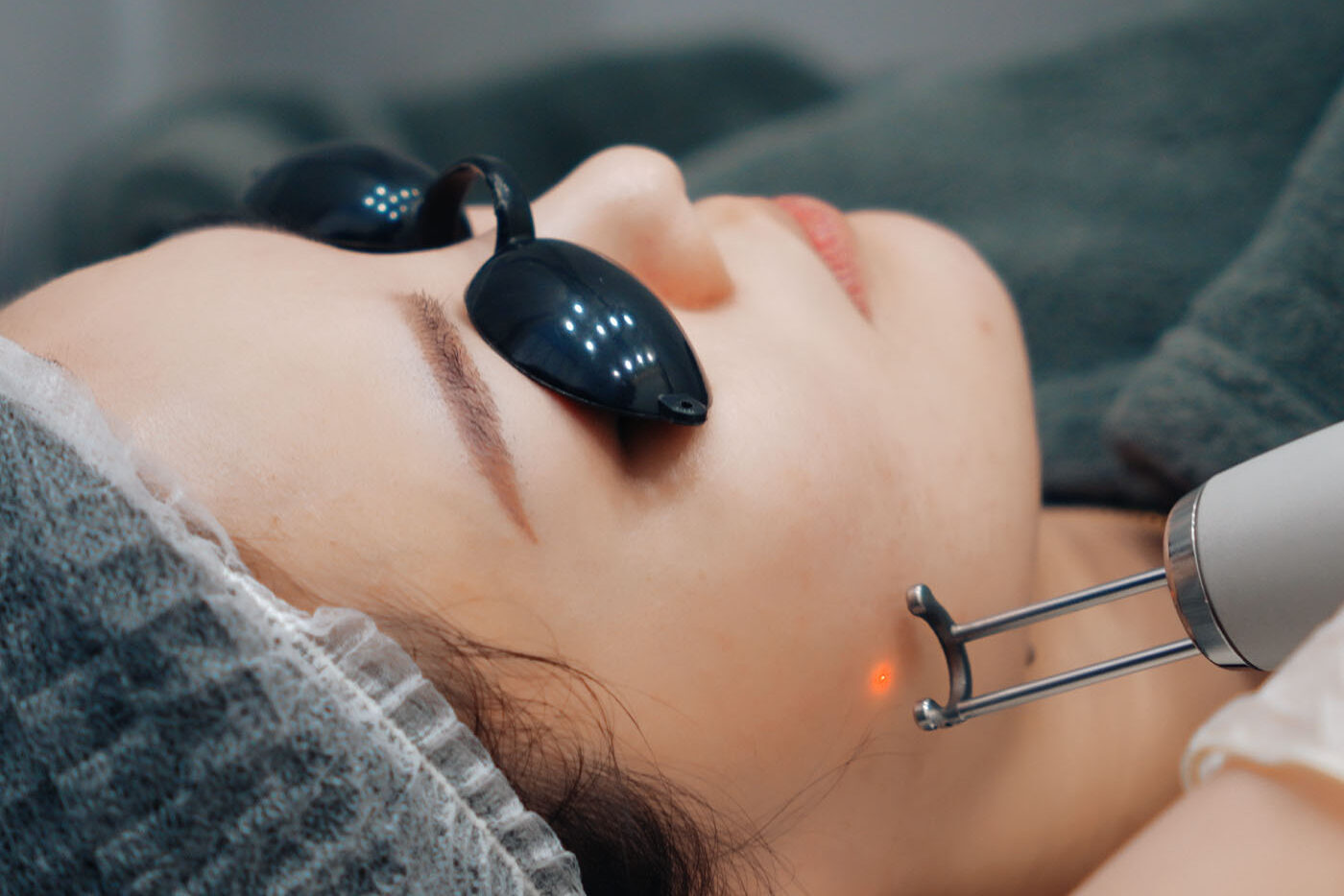 Pico Laser Is Surprisingly Great For Asian Skin!