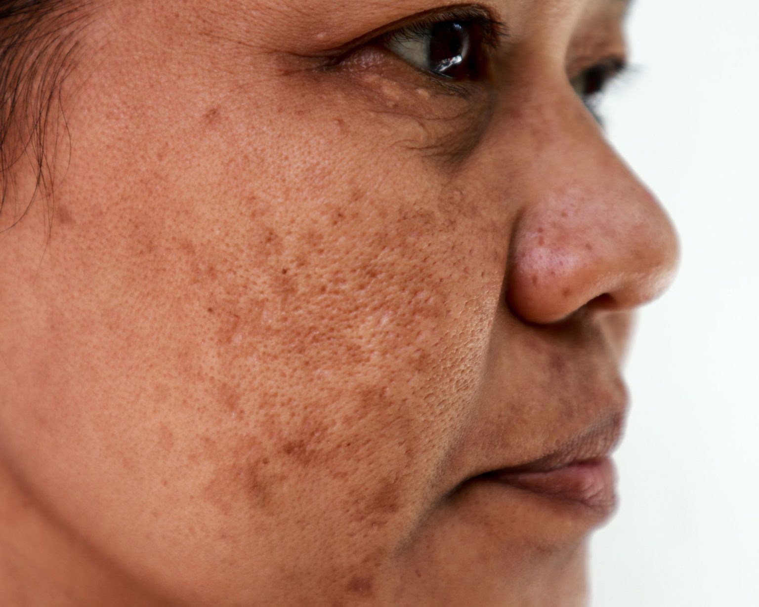 Pico Laser for Melasma: Restoring Skin Clarity