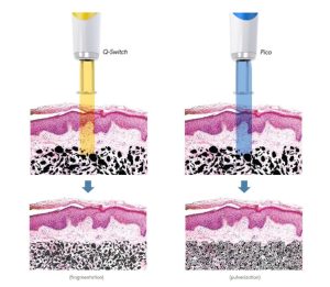 Pico Laser Treatment in Singapore: A Complete Guide