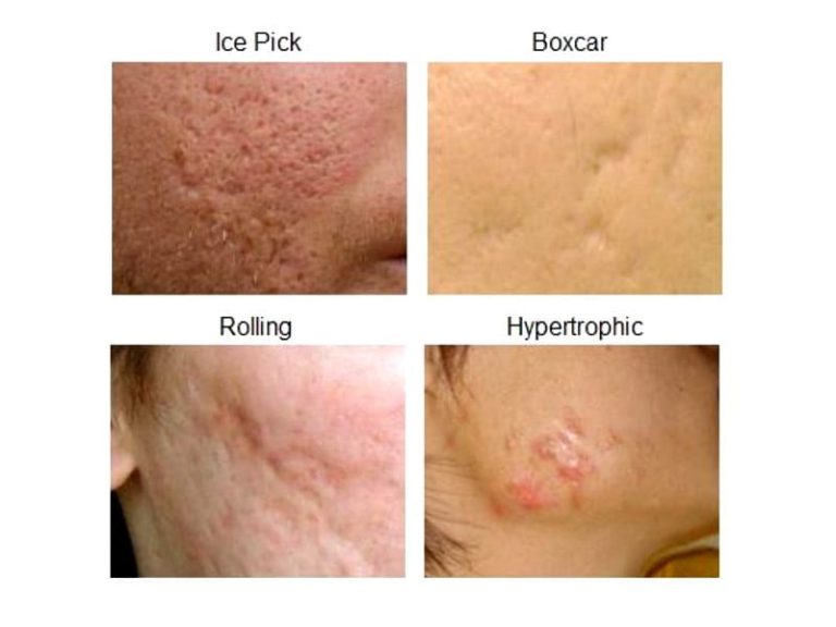 Acne Scars: What Are The Causes, Types and Non-Surgical Treatment in ...