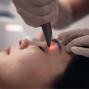 A Guide To 9D Perfect V FaceLift in SIngapore