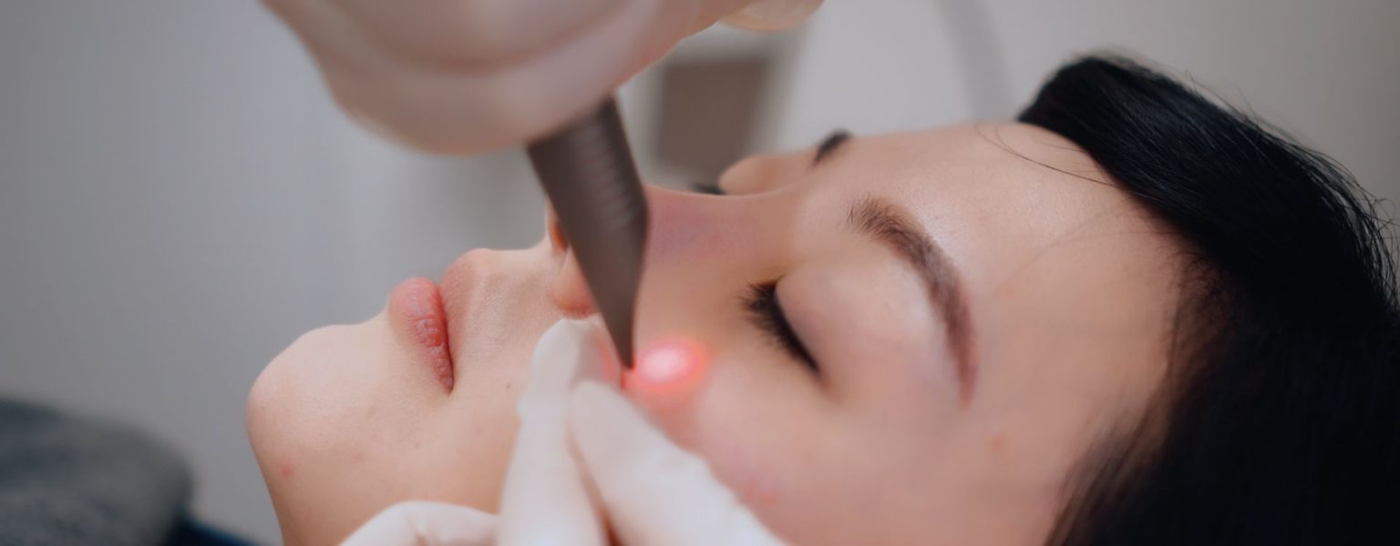 A Guide To 9D Perfect V FaceLift in SIngapore